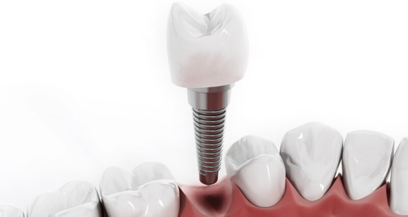 Smile with Natural Looking Dental Implant - Eot Clinic Turkey