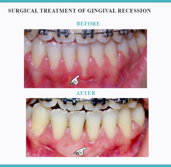 Smile Gallery - Eot Clinic Turkey
