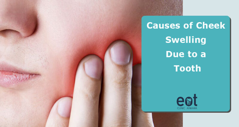 Causes of Cheek Swelling Due to a Tooth - Eot Clinic Turkey